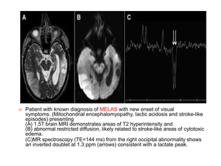 MRI spectroscopy- Its Application, Principle & Techniques | PPTX