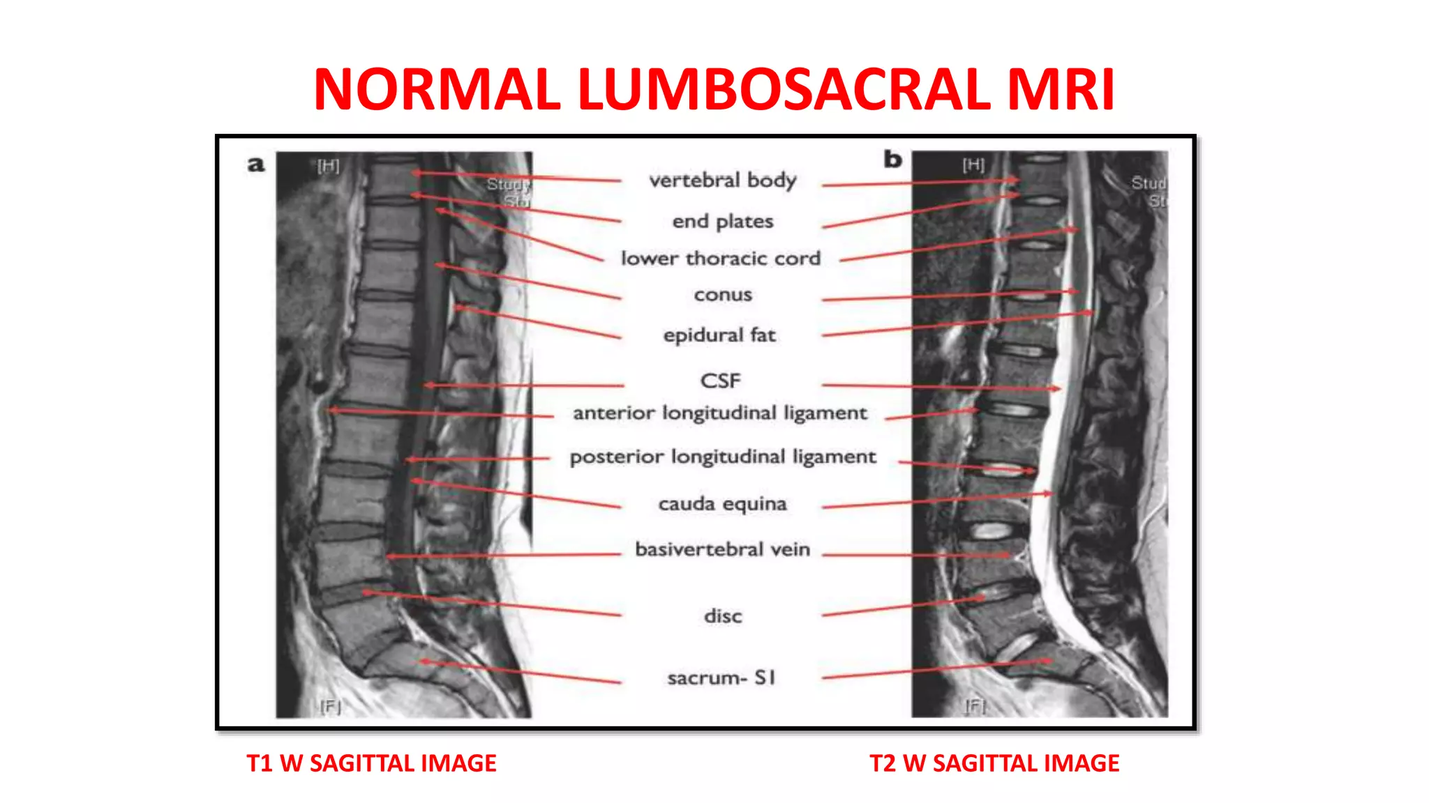 MRI SPINE ANATOMY | PPTX