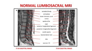 Lumbar Spine Mri Labeled