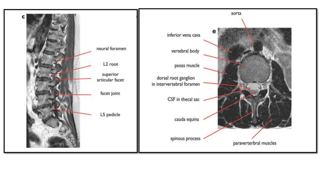 MRI SPINE ANATOMY