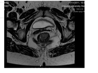 MRI Staging of Early Rectal Tumours- Gina Brown | PPT