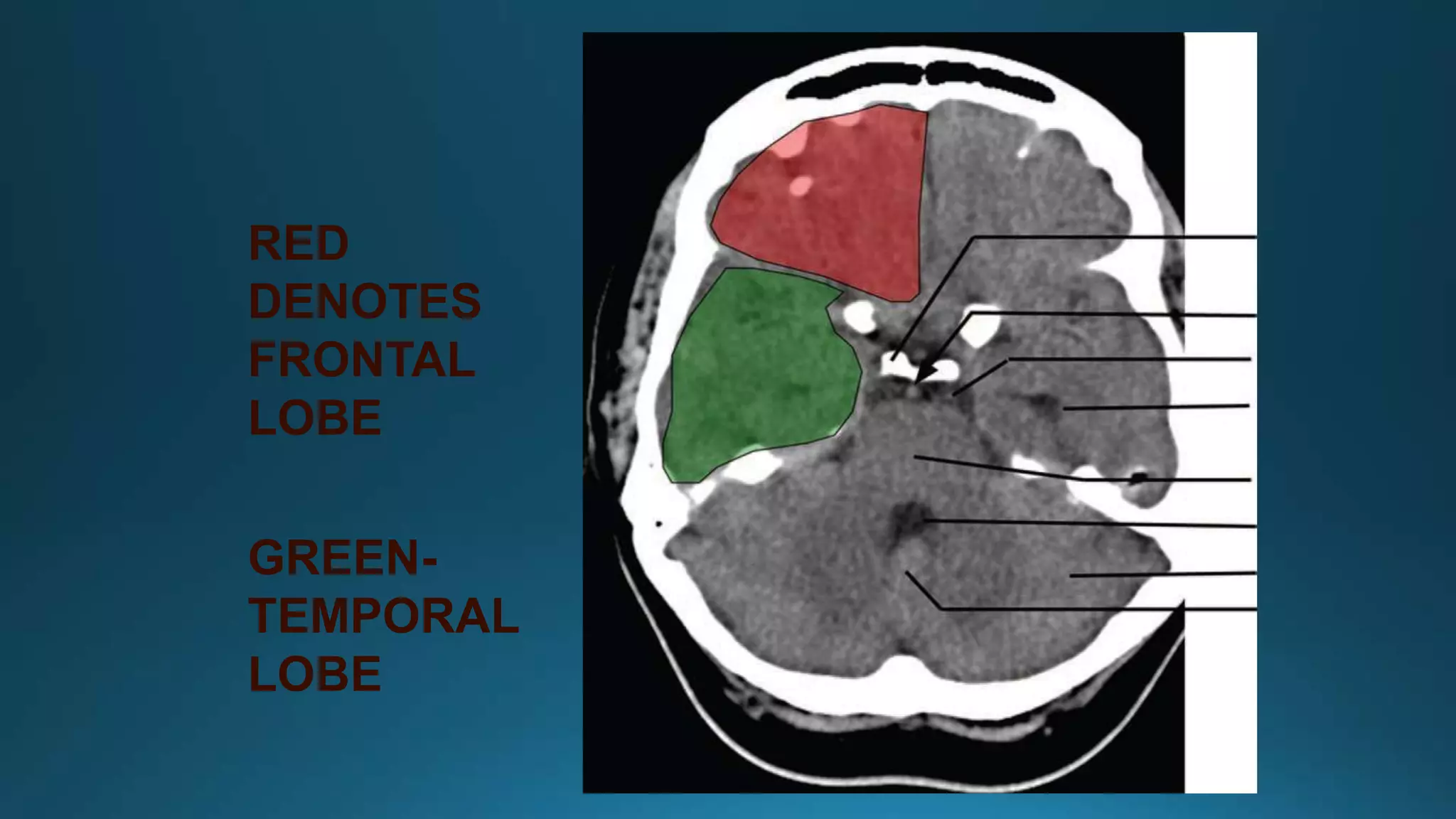 MRI Stroke | PPTX
