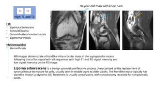MRI signal intensity approach to synovial masses | PPTX