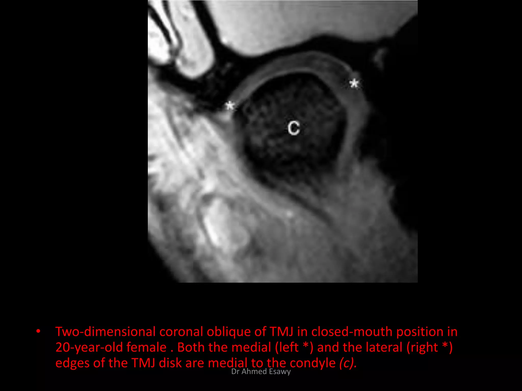 MRI TMJ temporo mandibular jiont Dr Ahmed Esawy | PDF