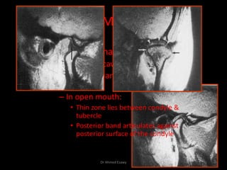 MRI TMJ temporo mandibular jiont Dr Ahmed Esawy | PDF