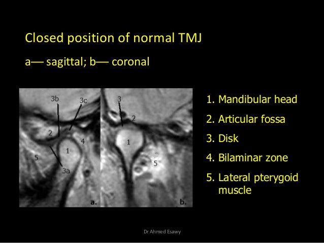 MRI TMJ temporo mandibular jiont Dr Ahmed Esawy