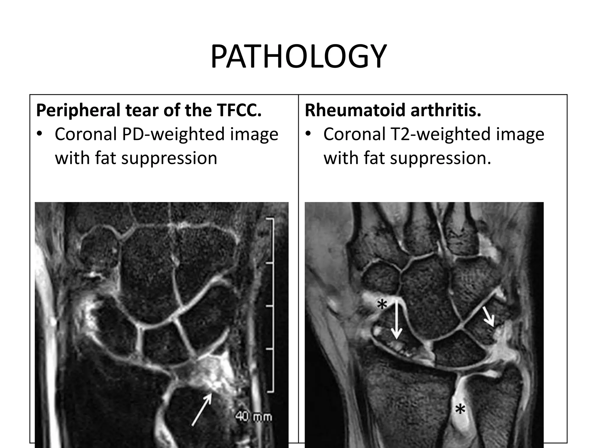 MRI WRIST SCAN PLANE AND LOCATION | PPTX