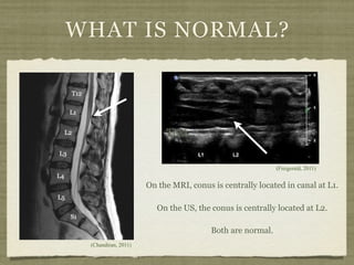 MRI and X-Ray of the Neonate Spine | PDF