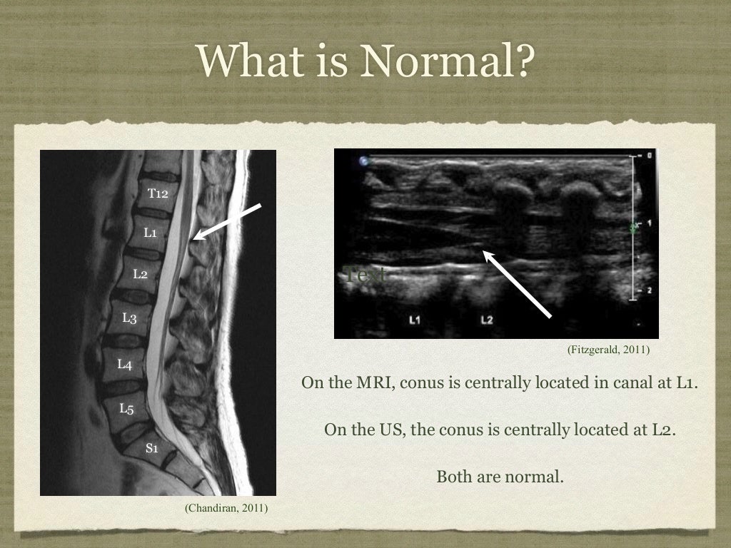 MRI and X-Ray of the Neonate Spine