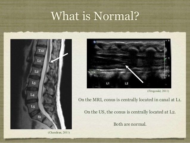 MRI and X-Ray of the Neonate Spine