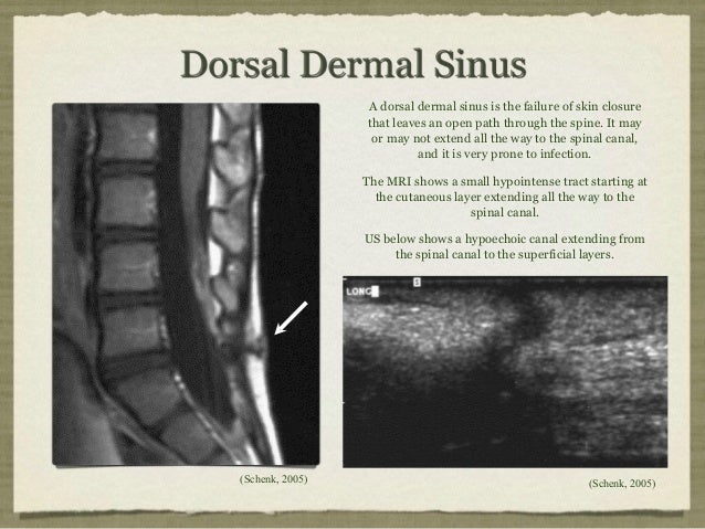 MRI and X-Ray of the Neonate Spine
