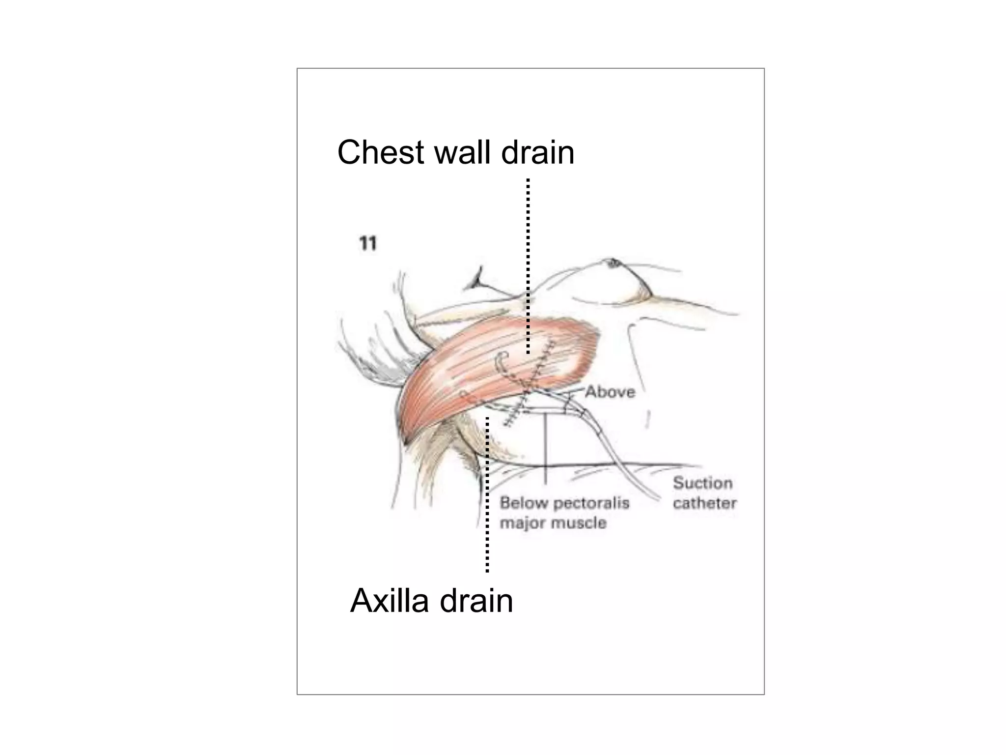 Modified Radical Masectomy | PPTX | Surgery | Medical Health
