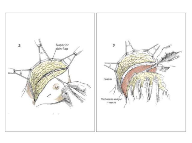 Modified Radical Masectomy | PPTX | Surgery | Medical Health