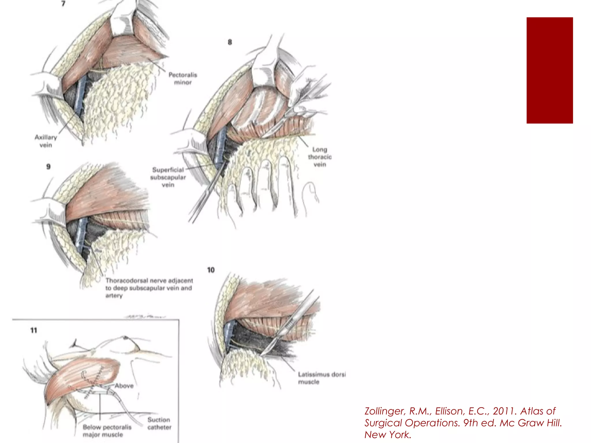 Modified Radical Mastectomy (Optek) | PPT