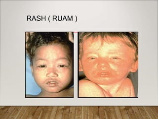 imunisasi measles rubella indonesia puskesmas | PPT