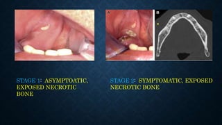 Mronj ppt | PPTX