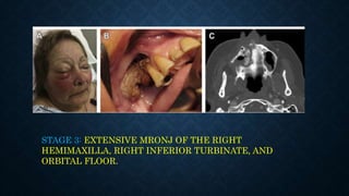 Mronj ppt | PPTX