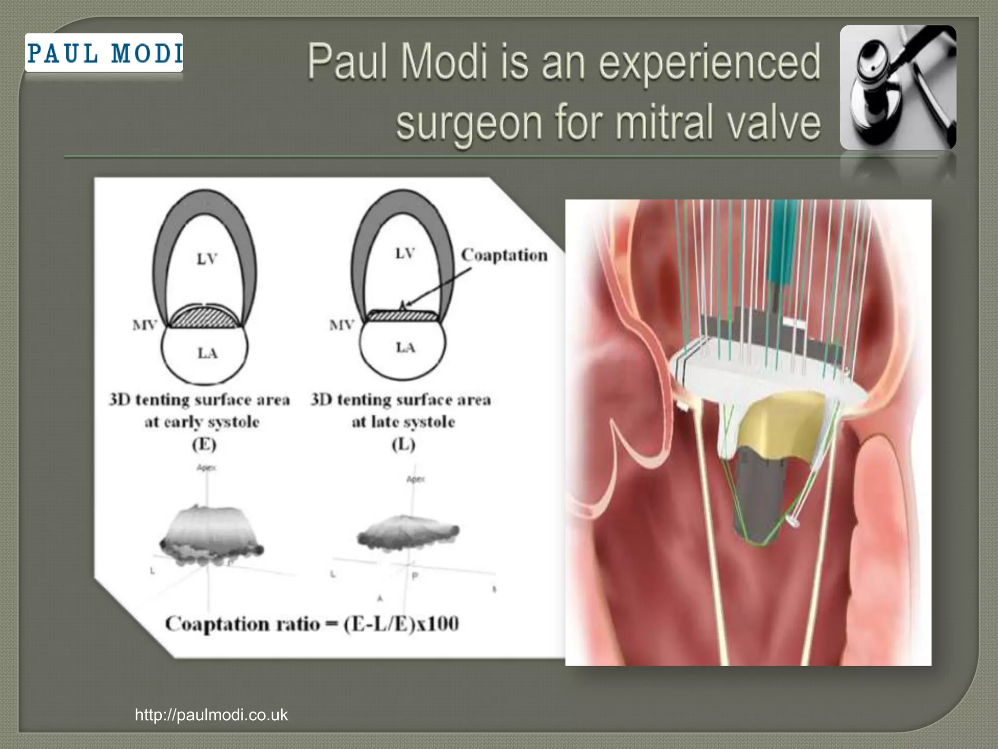 mitral valve repair | PPTX