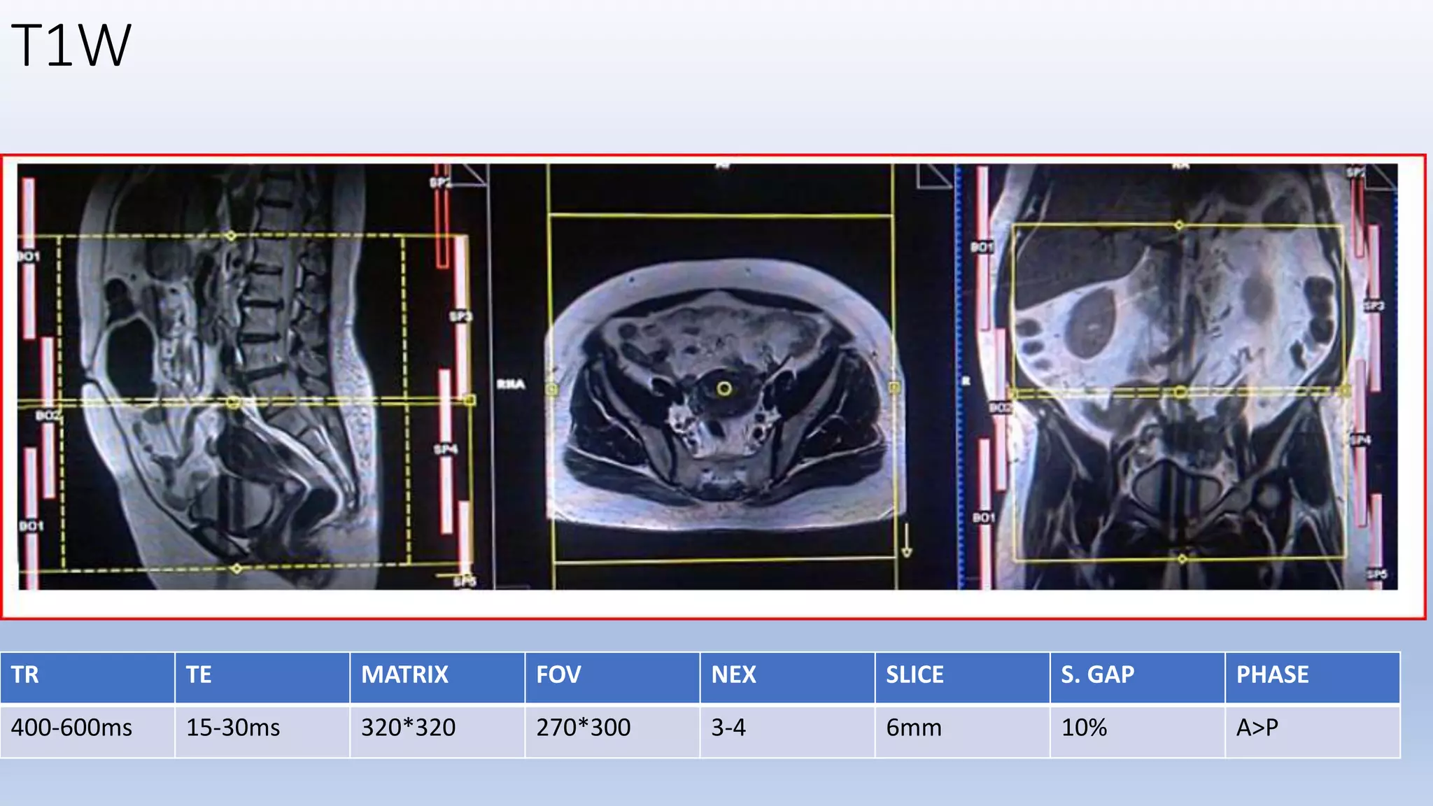 Mr procedure of pelvis and hip joint | PPTX