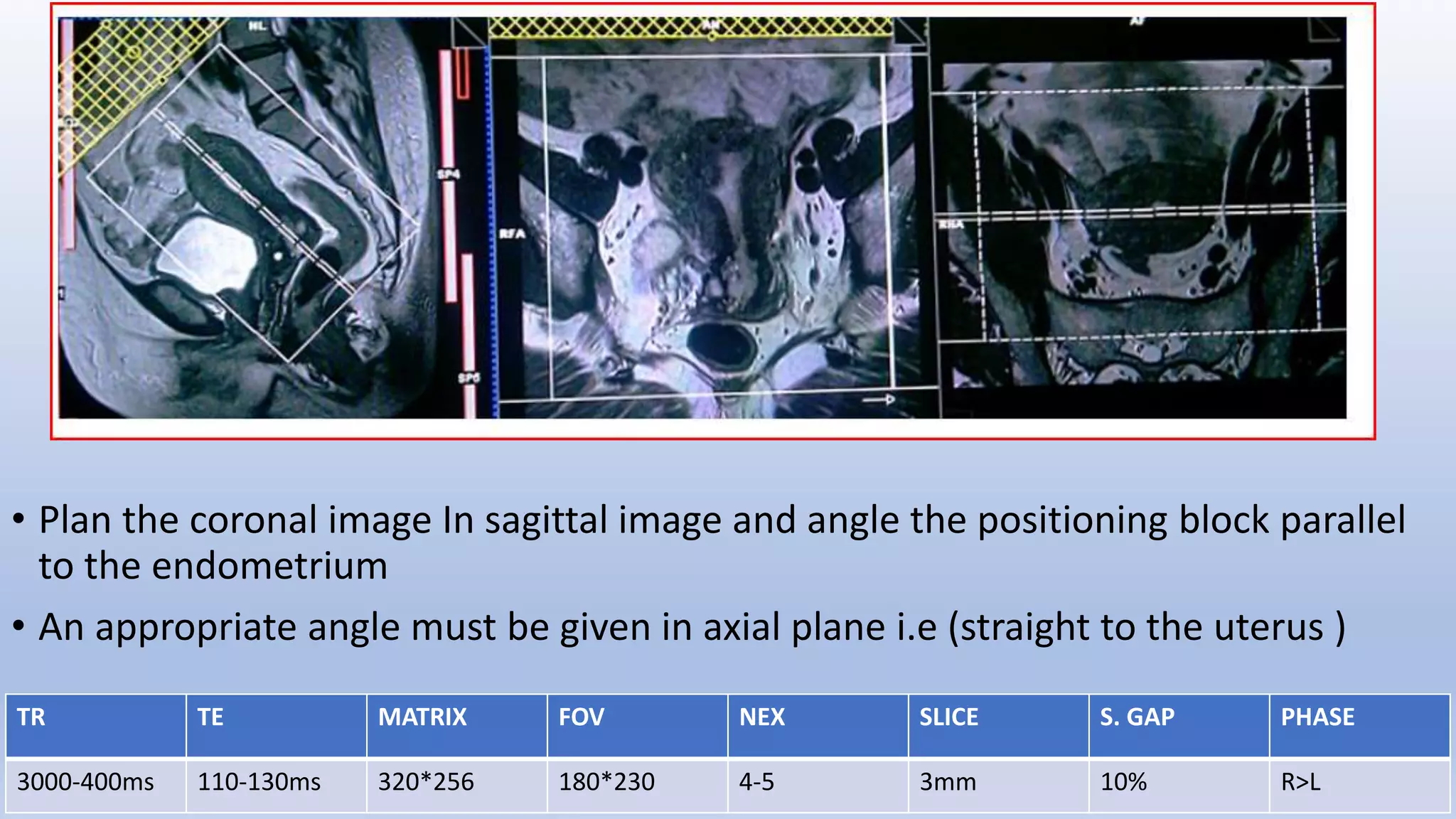 Mr procedure of pelvis and hip joint | PPTX