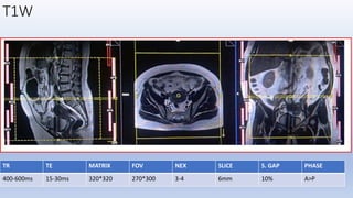 Mr procedure of pelvis and hip joint | PPTX