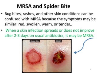 Mrsa | PPSX