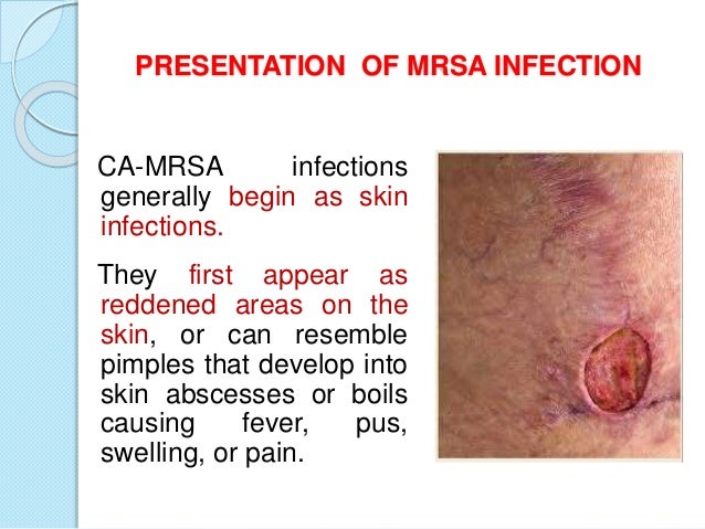 MRSA AN UPDATE