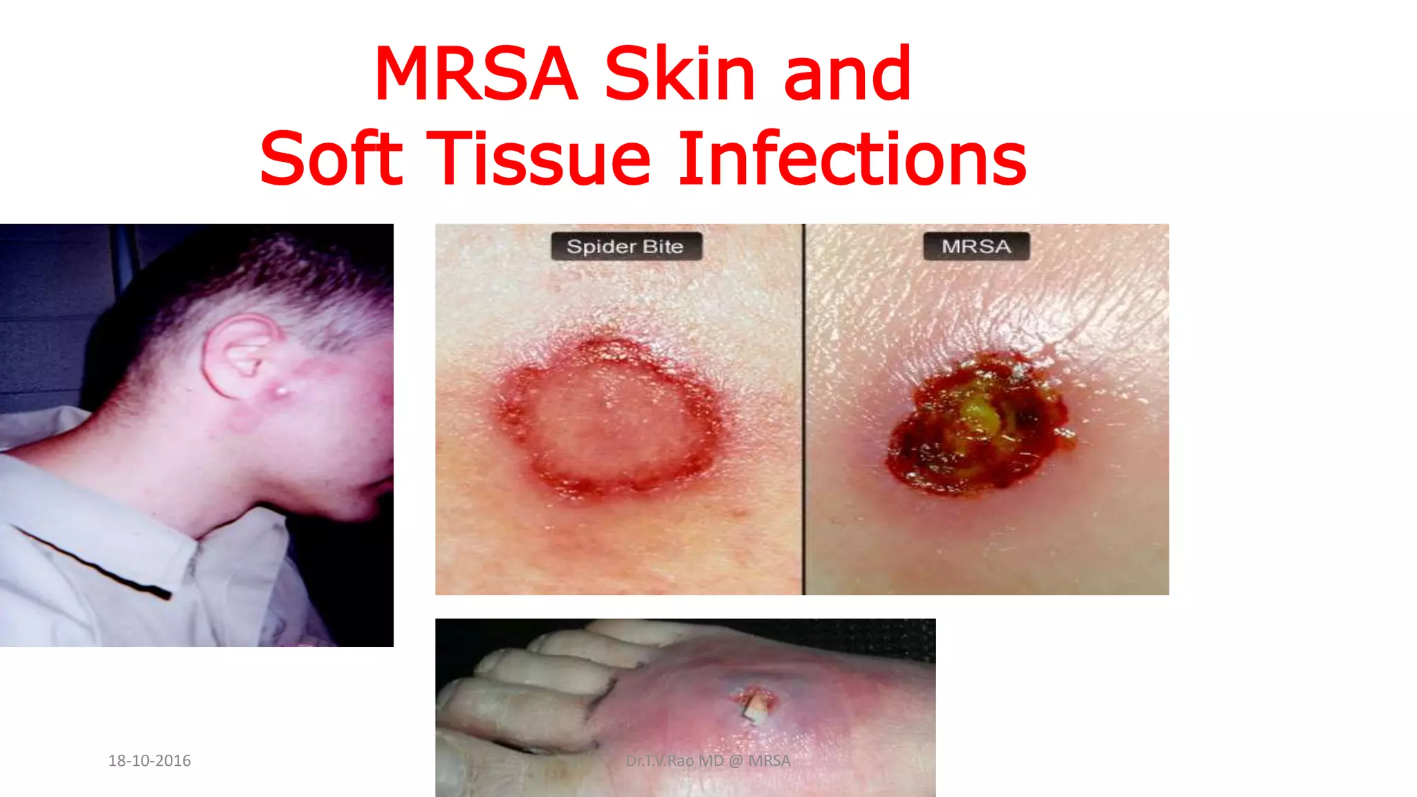 MRSA INFECTIONS basics, implications, and prevention | PPTX
