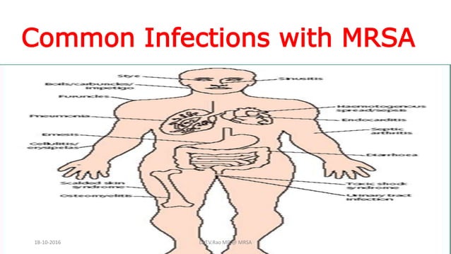 MRSA INFECTIONS basics, implications, and prevention | PPTX