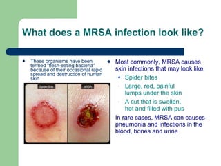 Mrsa ppt | PPT
