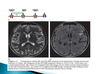 BASIC MRI SEQUENCES | PPTX