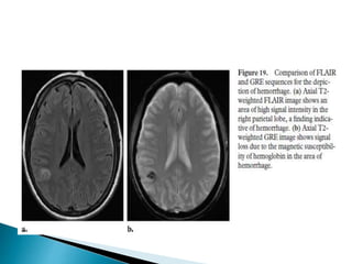 BASIC MRI SEQUENCES | PPTX