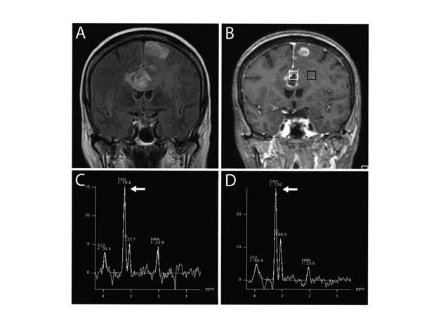 MRS magnetic resonance spectroscopy IN CNS.pptx