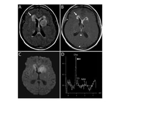 MRS magnetic resonance spectroscopy IN CNS.pptx