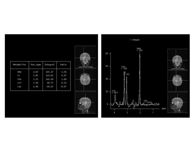 MRS magnetic resonance spectroscopy IN CNS.pptx