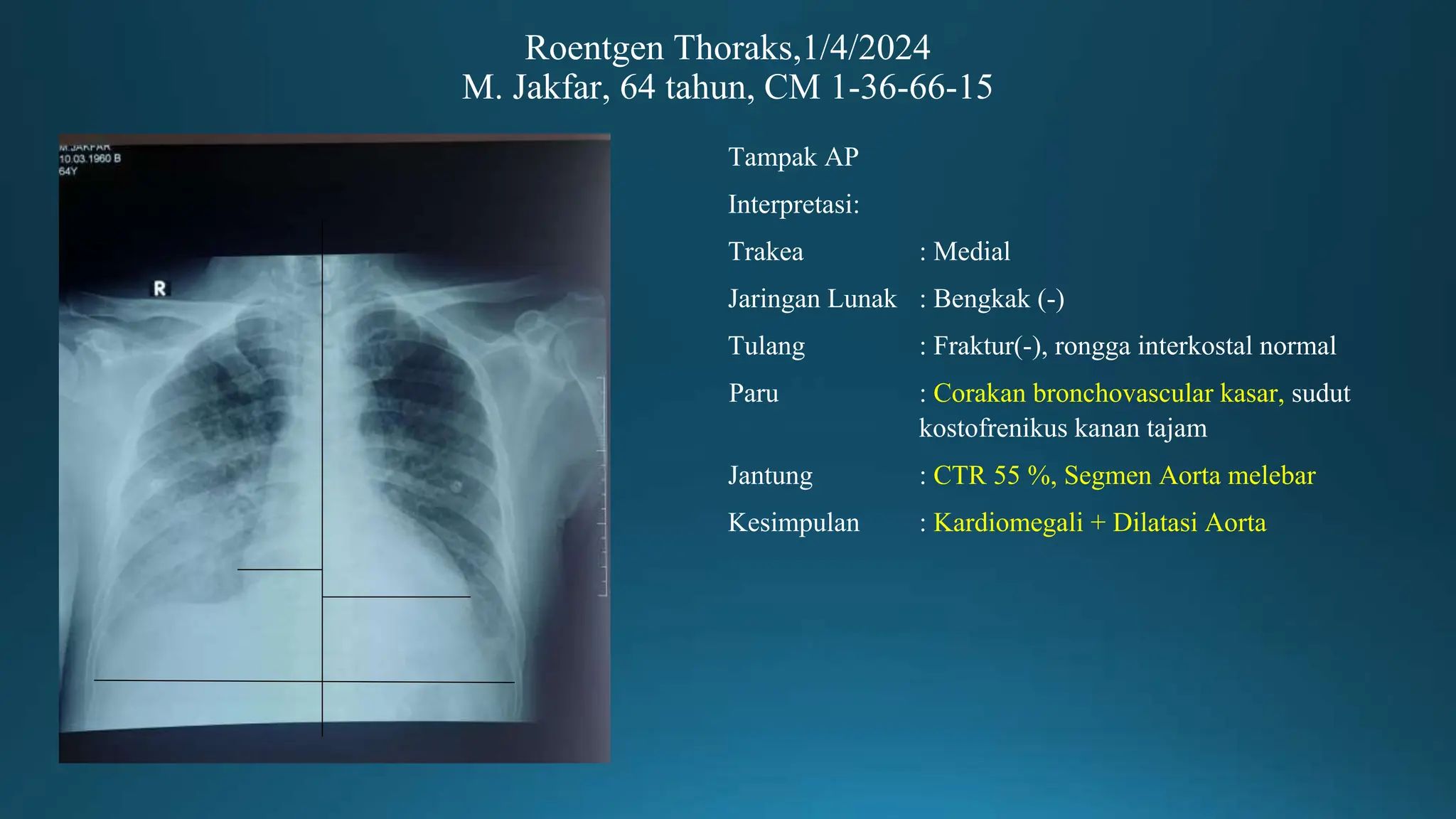 MR Slide Heart Failure April 2024 an M Jakfar.pptx