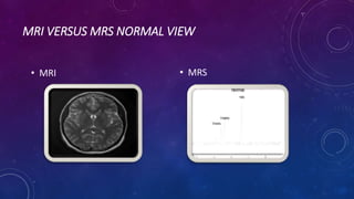 Magnetic resonance spectroscopy | PPTX