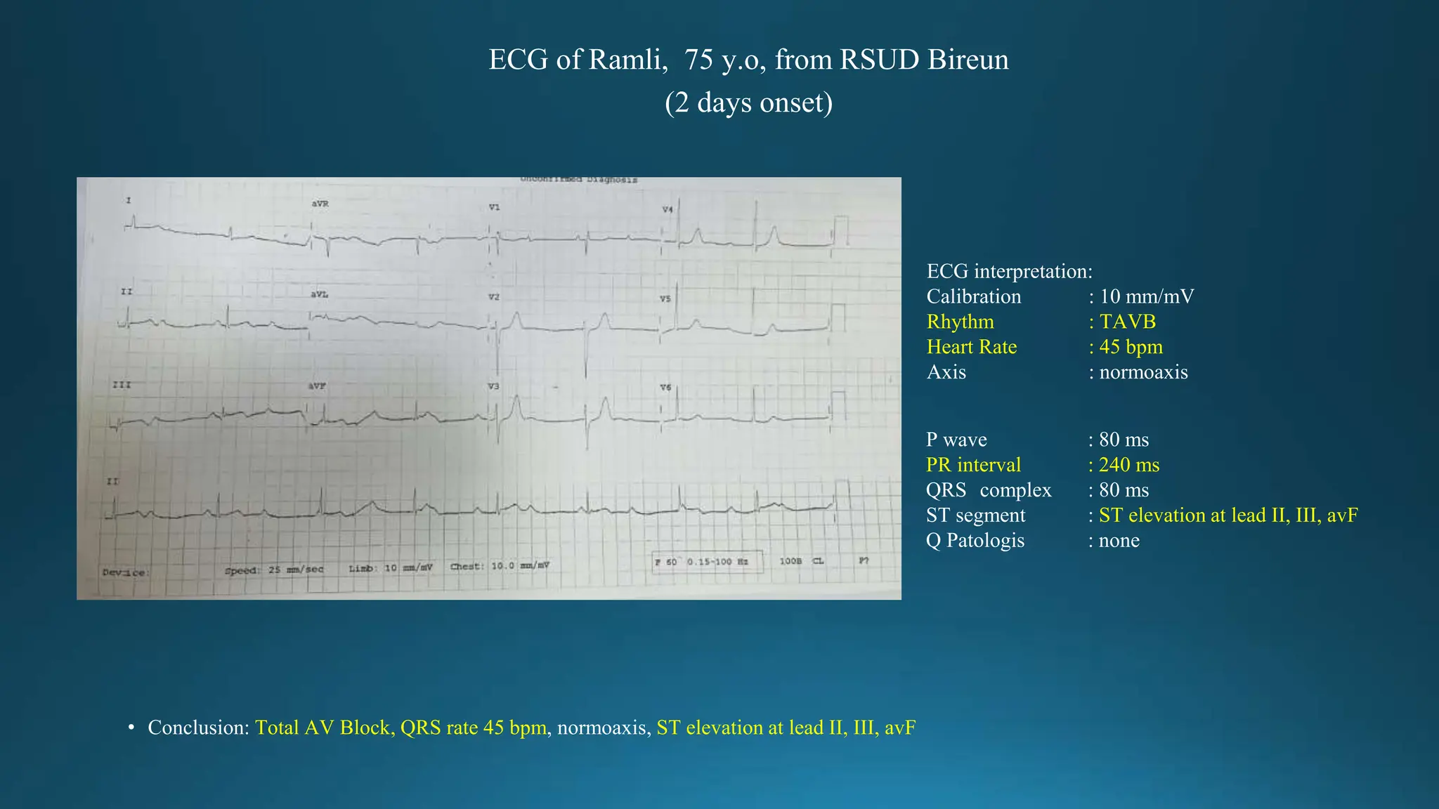 Case Report STEMI English with total AV Block.pptx