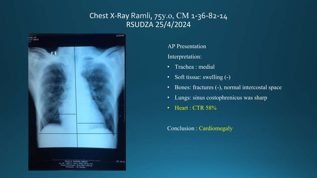 Case Report STEMI English with total AV Block.pptx