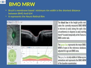 MRW , RNFL . MINIMUM RIM WIDTH , RETINAL NERVE FIBRE LAYER ANALYSIS | PPTX