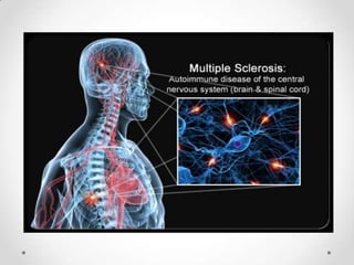 Multiple Sclerosis | PPT
