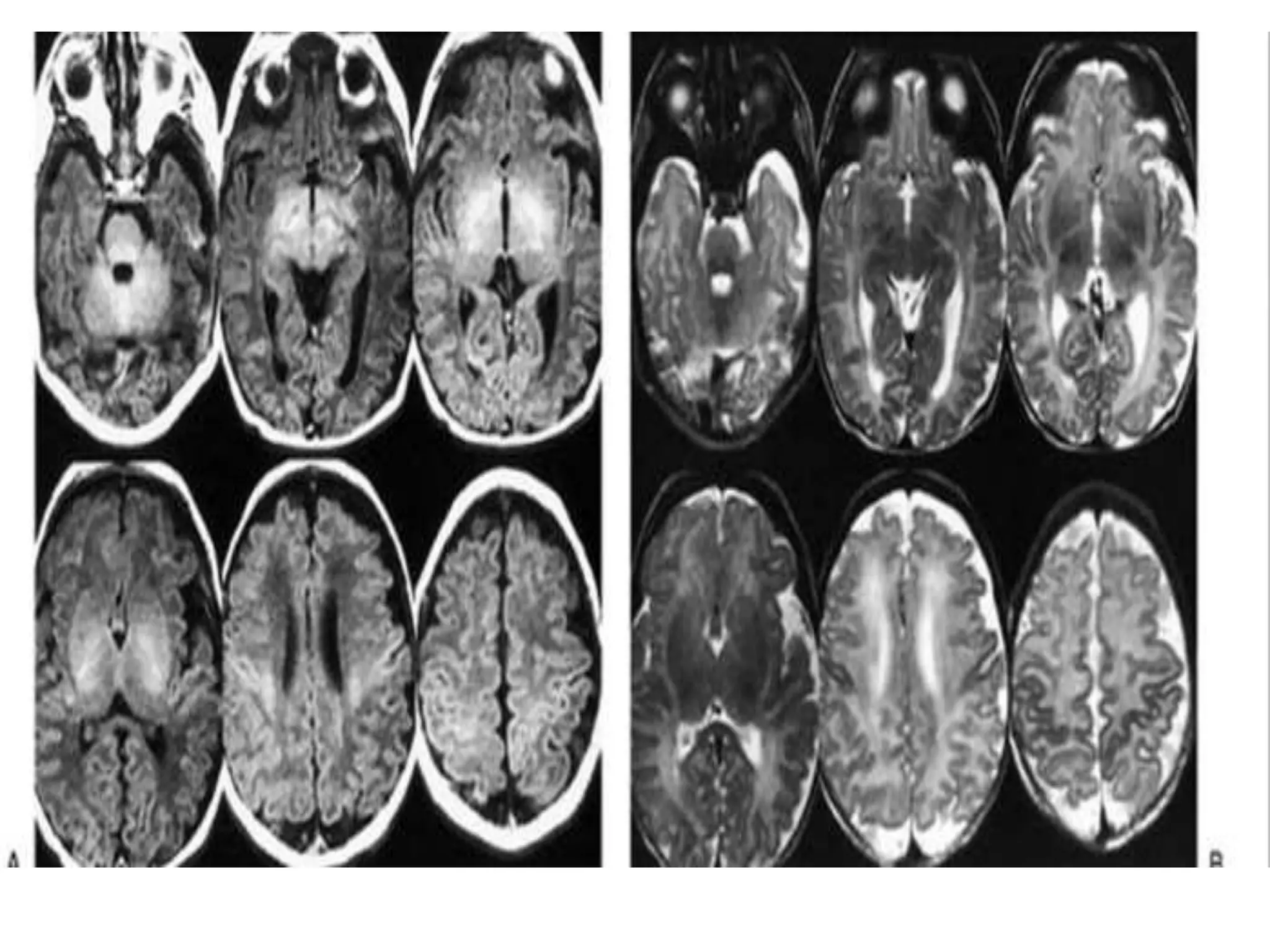 imaging of multiple sclerosis | PPTX