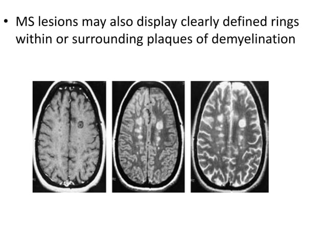 imaging of multiple sclerosis | PPTX | Brain and Nervous System ...