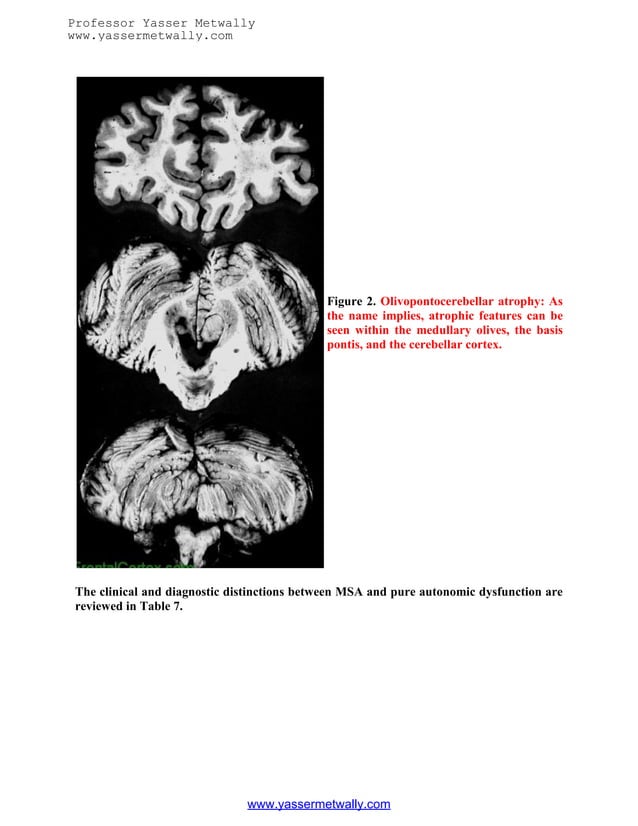 Radiological pathology of multisystem atrohpy | PDF