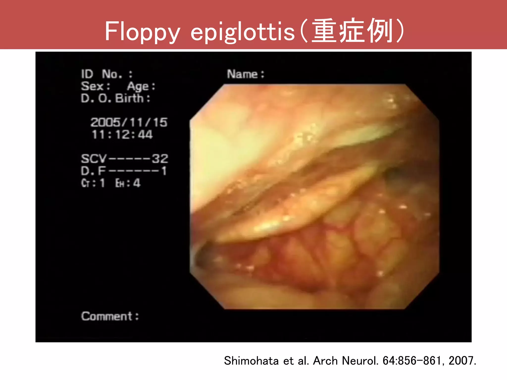 MSA -Sleep, Sudden death, Ethics- | PDF