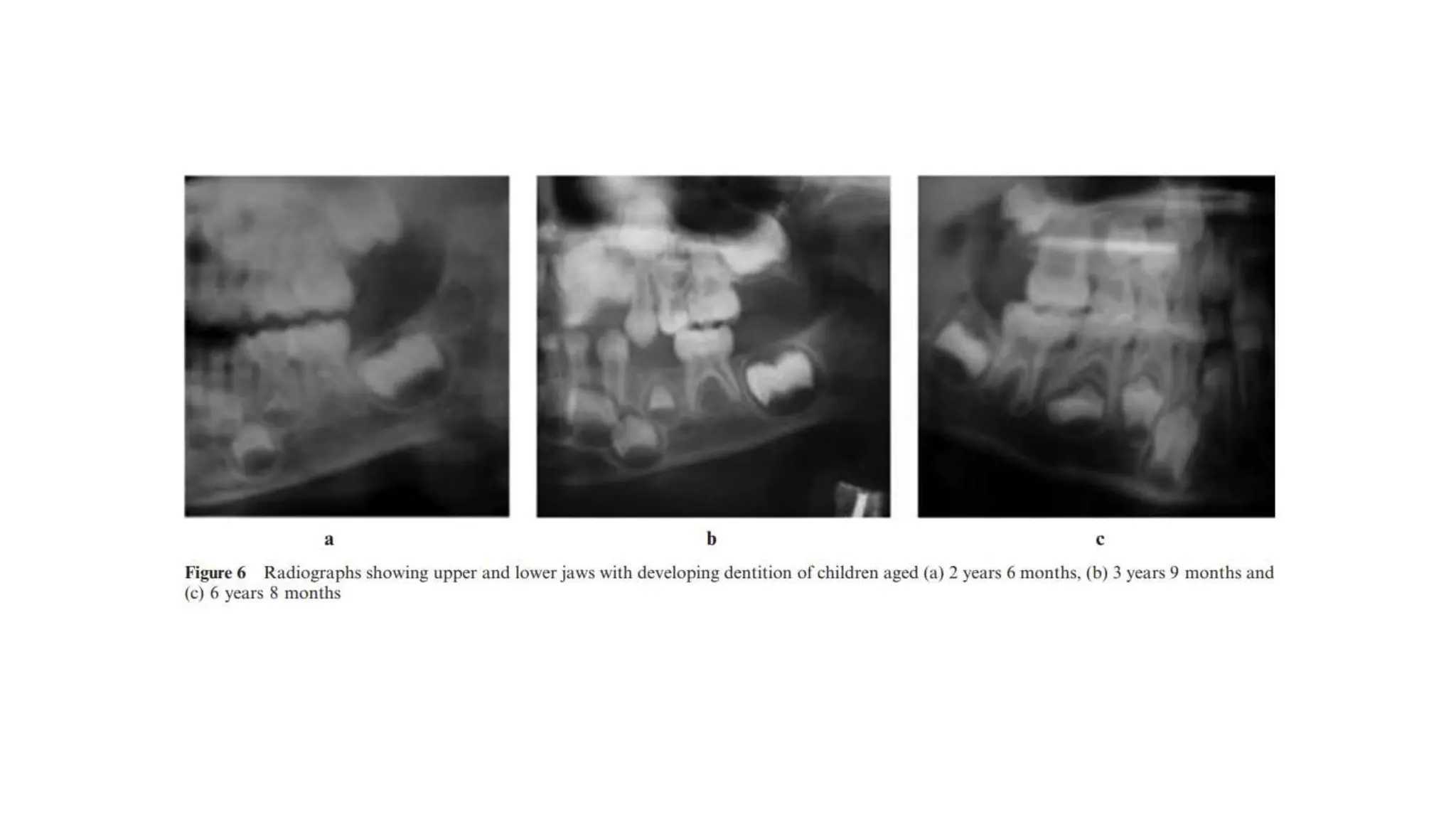 Msciii Forensic Anthropology Age Estimation Using Dentition Pptx