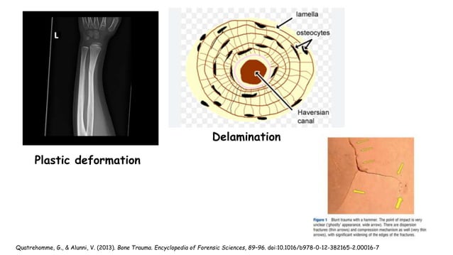 MSCIII_Forensic anthropology_Trauma analysis.pptx | Death, Injury, or ...