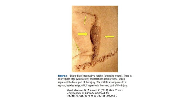 MSCIII_Forensic anthropology_Trauma analysis.pptx | Death, Injury, or ...
