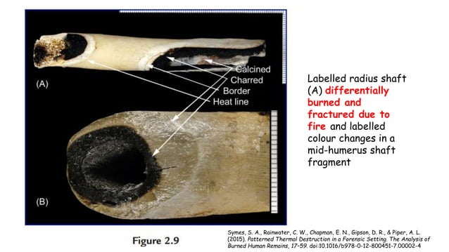 MSCIII_Forensic anthropology_Trauma analysis.pptx | Death, Injury, or ...