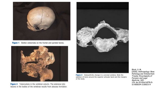 MSCIII_Forensic anthropology_Trauma analysis.pptx | Death, Injury, or ...